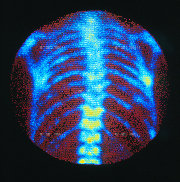 F/col gamma bone scan showing secondary cancer[01809036358]の写真素材・イラスト素材 ...