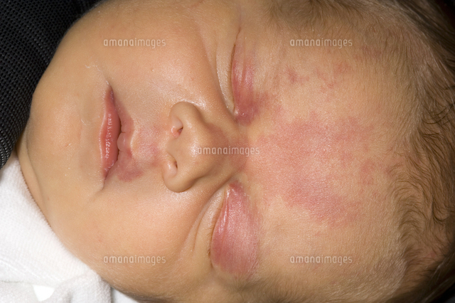 Baby with stork bite birthmarks[01809038653]の写真素材・イラスト素材｜アマナイメージズ