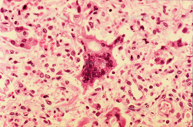 Giant cell under light microscopy[11015304048]の写真素材・イラスト素材｜アマナイメージズ