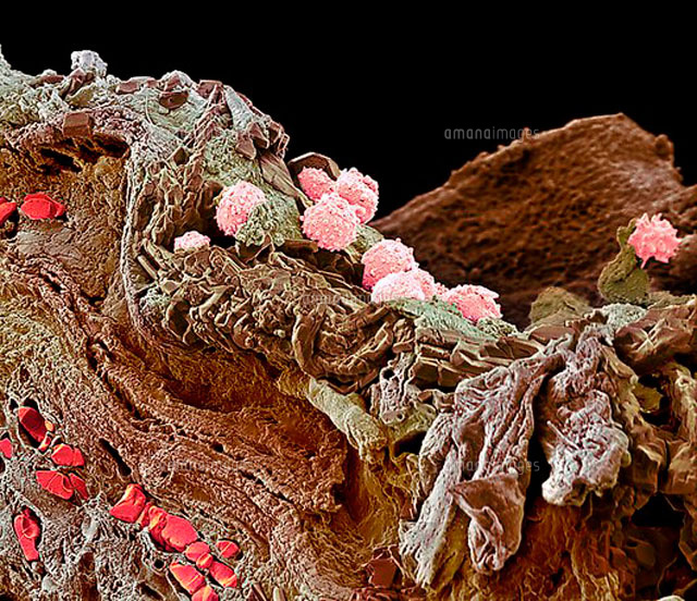 Pyoderma skin disease，SEM[11068001993]の写真素材・イラスト素材｜アマナイメージズ